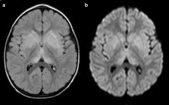 Neuroradiology of human prion diseases, diagnosis and differential ...