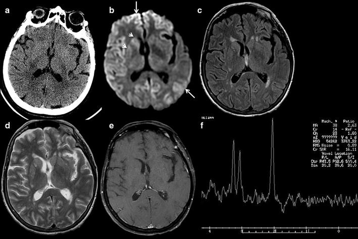 Neuroradiology of human prion diseases, diagnosis and differential ...