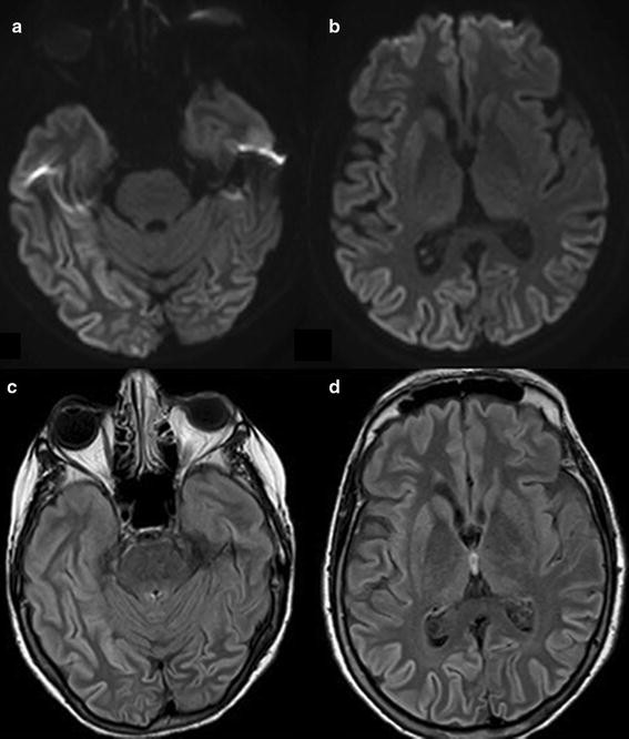 Neuroradiology of human prion diseases, diagnosis and differential ...