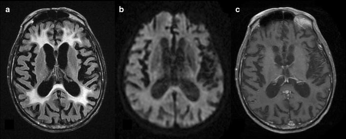 Neuroradiology of human prion diseases, diagnosis and differential ...