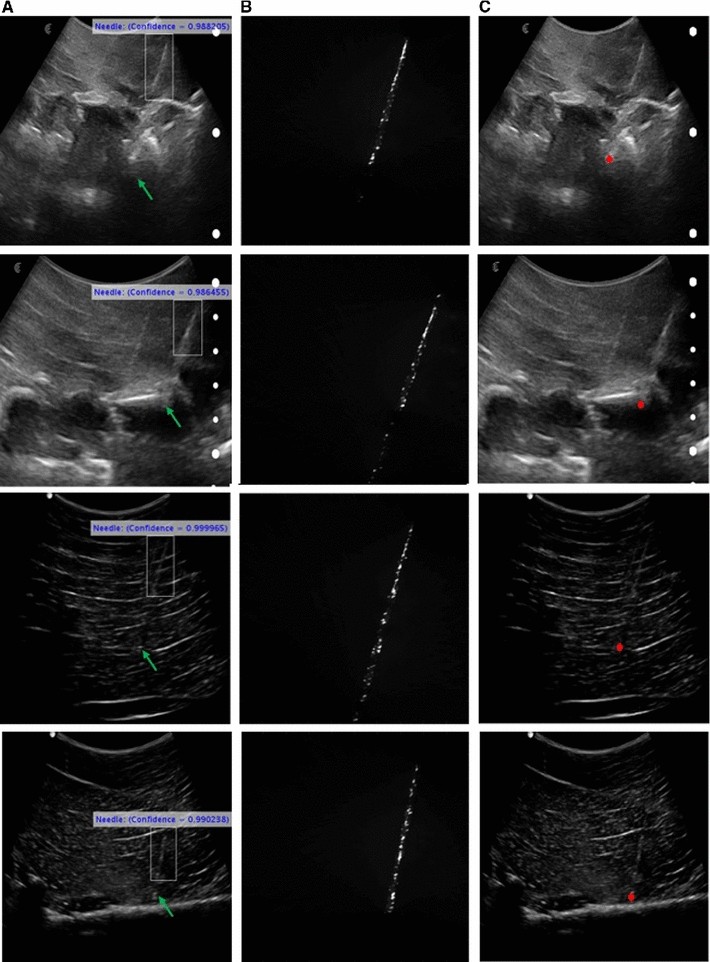 Convolution neural networks for real-time needle detection and ...