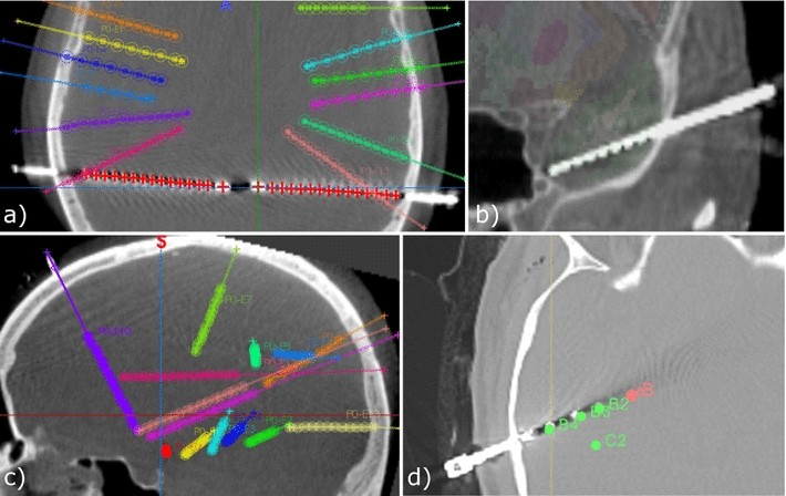 Automatic segmentation of stereoelectroencephalography (SEEG ...