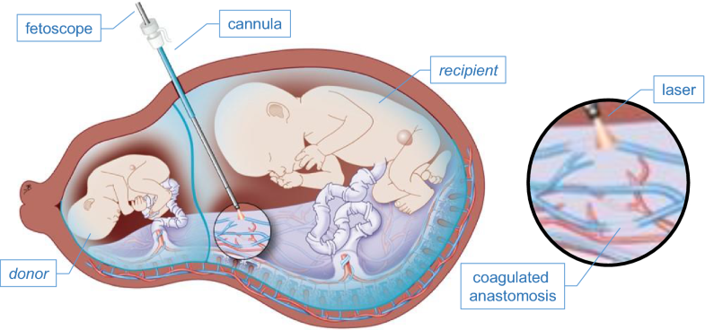 A mixed-reality surgical trainer with comprehensive sensing for fetal ...