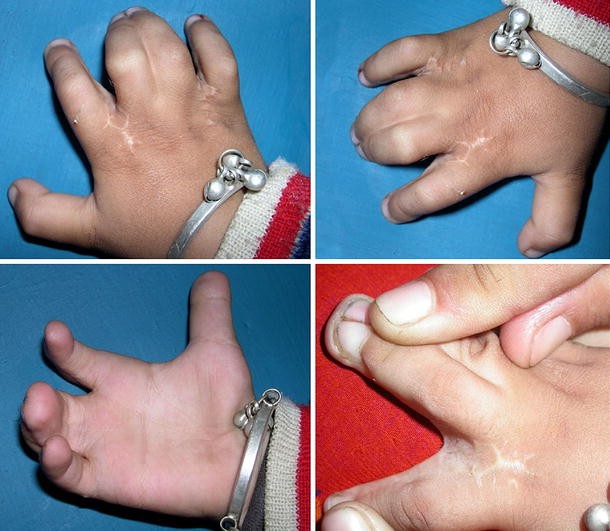 End-of-Skin Grafts in Syndactyly Release: Description of a New Flap for ...