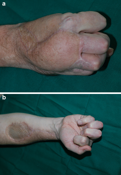 The Evolution of the Pedicled Radial Forearm Flap | SpringerLink