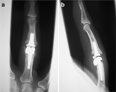Proximal Interphalangeal Joint Replacement with Surface Replacement ...