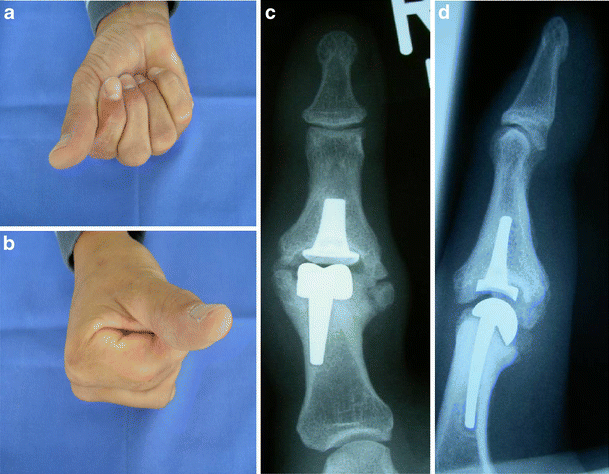 Proximal Interphalangeal Joint Replacement with Surface Replacement ...