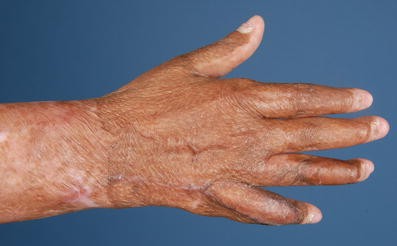 The Dorsal Metacarpal Artery Perforator Flap: A Case Report Utilizing a ...