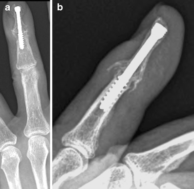 Treatment of Symptomatic Distal Interphalangeal Joint Arthritis with ...