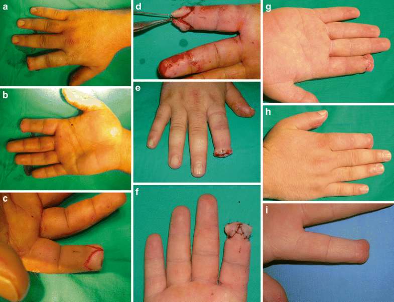 Bilateral V–Y rotation advancement flap for fingertip amputations ...