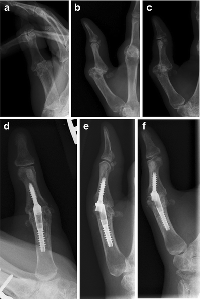 MCP arthrodesis using an intramedullary interlocking device | SpringerLink