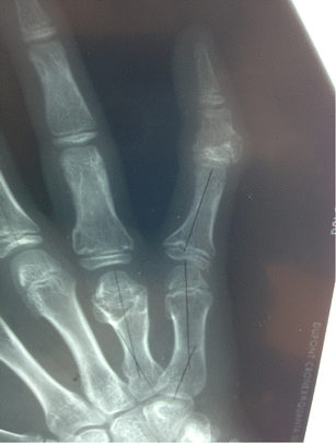 Multiple osteochondroma of the hand: initial and long-term follow-up ...