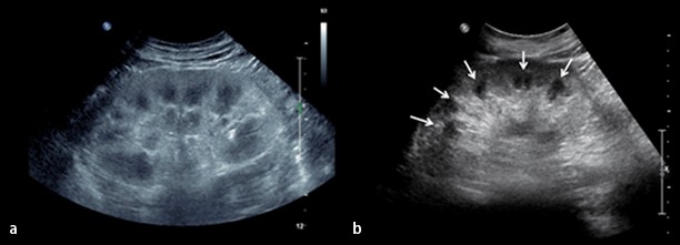 Sonographie in der Diagnostik des akuten Nierenversagens | SpringerLink