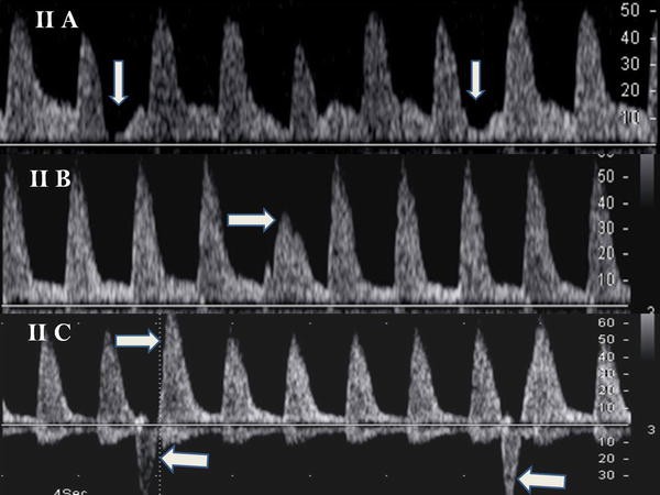 A classification of patterns of fetal middle cerebral artery velocity ...