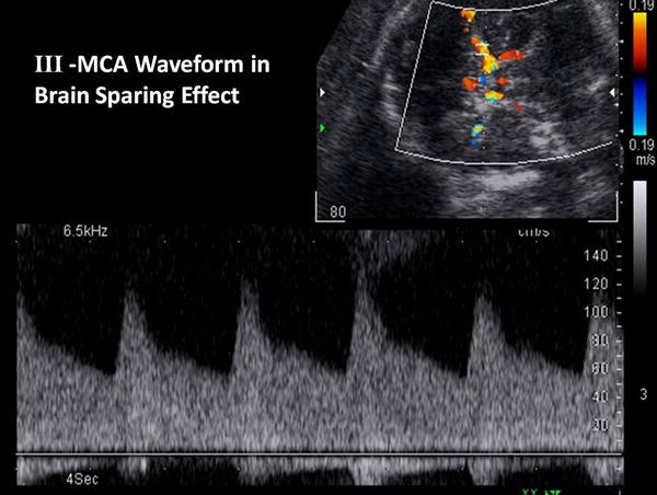 A classification of patterns of fetal middle cerebral artery velocity ...