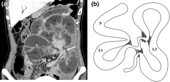 Multidetector CT appearance of adhesion-induced small bowel ...