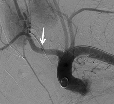Tracheo-innominate artery fistula successfully treated by endovascular ...