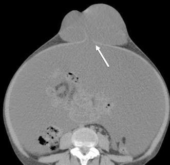 Incarceration of umbilical hernia after radiological insertion of a ...