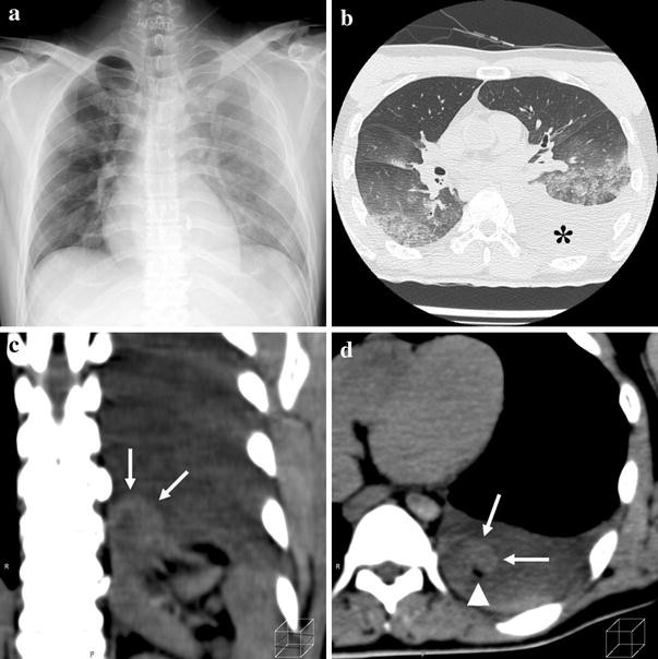 Postmortem radiography of gastromalacia: case reports | SpringerLink