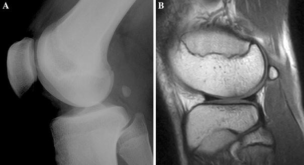 Potentially symptomatic fabella: MR imaging review | SpringerLink