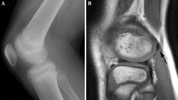 Potentially symptomatic fabella: MR imaging review | SpringerLink