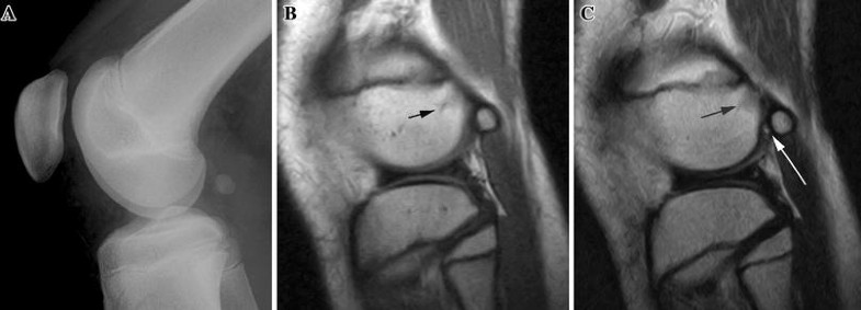 Potentially symptomatic fabella: MR imaging review | SpringerLink