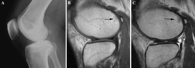Potentially symptomatic fabella: MR imaging review | SpringerLink
