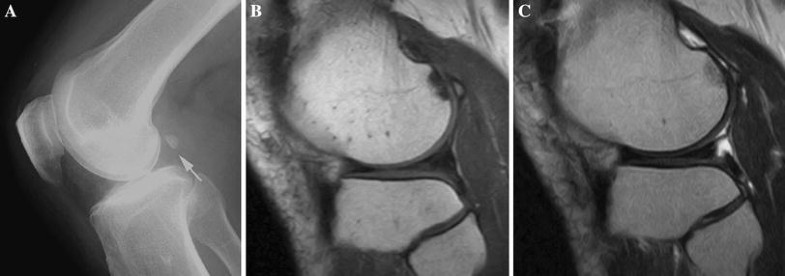 Potentially symptomatic fabella: MR imaging review | SpringerLink