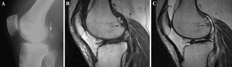 Potentially symptomatic fabella: MR imaging review | SpringerLink