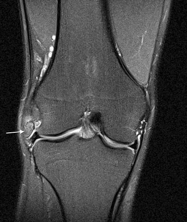 Sesamoiditis of the cyamella: imaging features of this rare ...