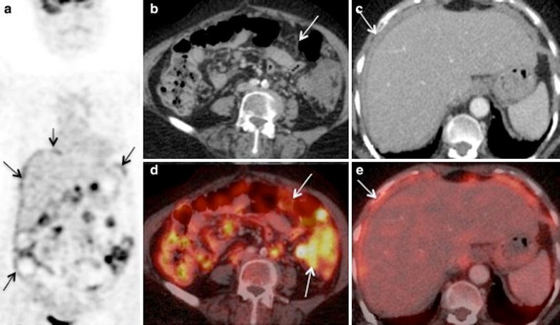 Imaging spectrum of peritoneal carcinomatosis on FDG PET/CT | SpringerLink