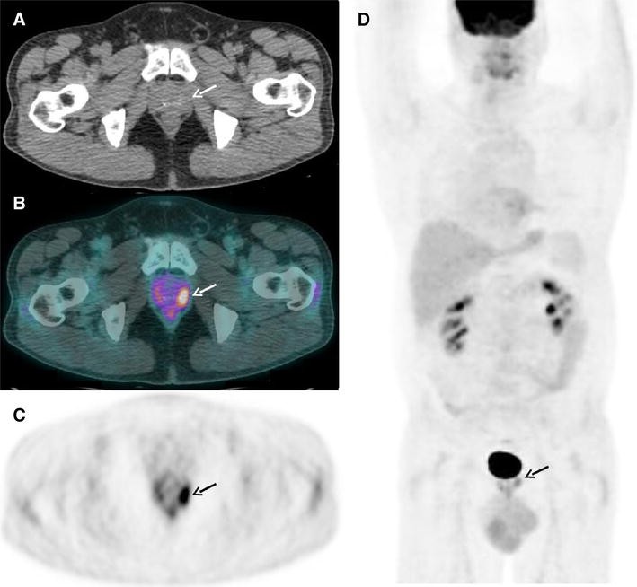 Multicentre study of 18F-FDG-PET/CT prostate incidental uptake ...