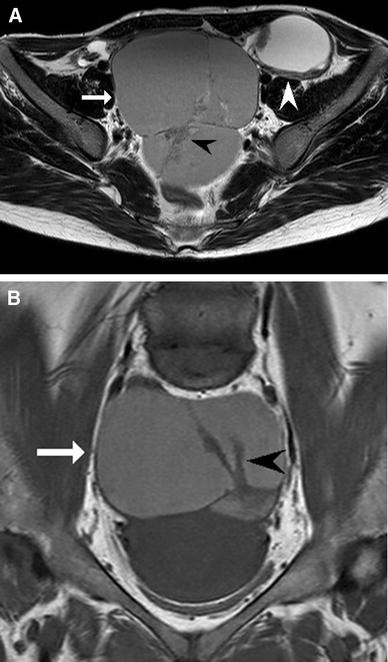 Revised FIGO staging system for cancer of the ovary, fallopian tube ...