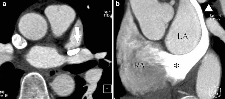 Incidence and appearances of coronary sinus anomalies in adults on ...