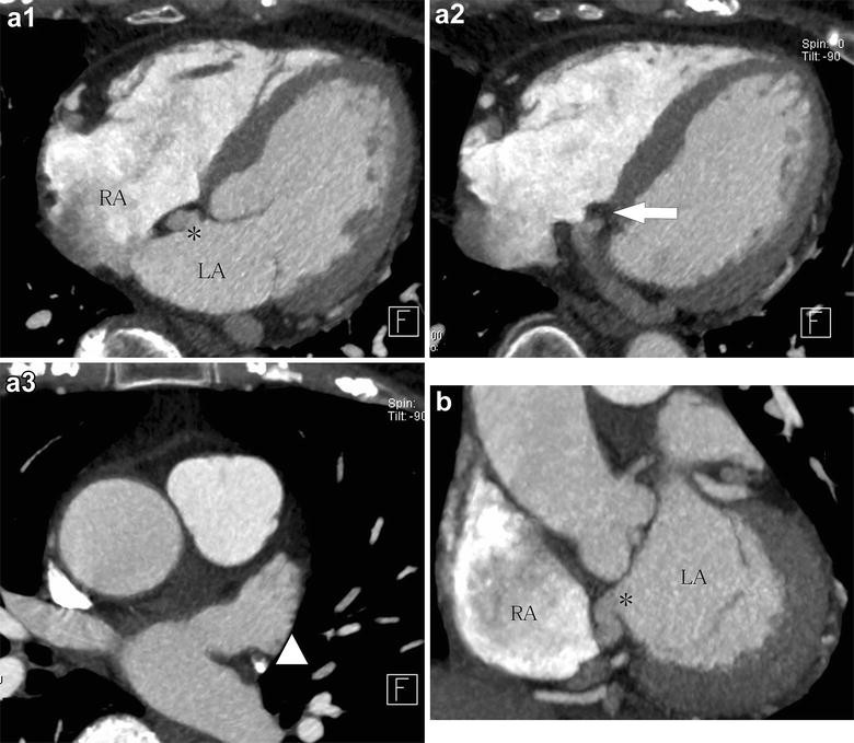 Incidence and appearances of coronary sinus anomalies in adults on ...