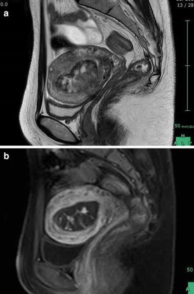 Multimodality imaging in secondary postpartum or postabortion ...
