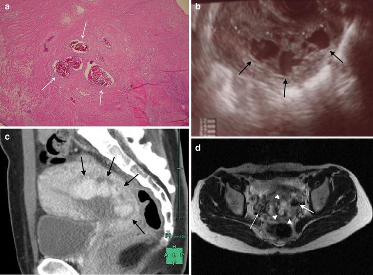 Multimodality imaging in secondary postpartum or postabortion ...