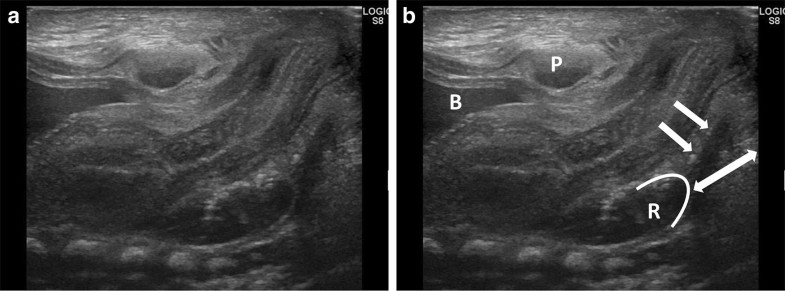 Ultrasound imaging of the anorectal malformation during the neonatal ...