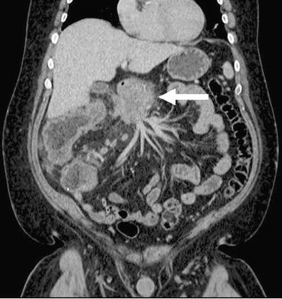 A Novel Technique to Relieve a Closed-Loop Obstruction Secondary to a ...