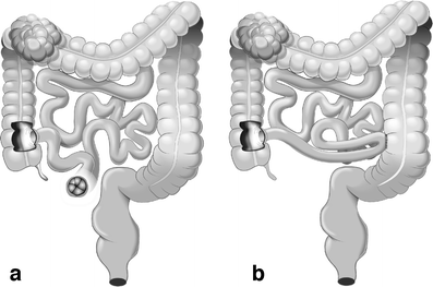 A Novel Technique to Relieve a Closed-Loop Obstruction Secondary to a ...