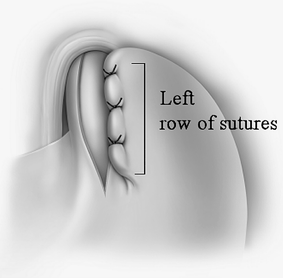 Laparoscopic Heller Myotomy and Dor Fundoplication for Esophageal ...