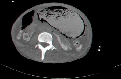 Acute Gastric Dilatation, Necrosis and Perforation Complicating ...