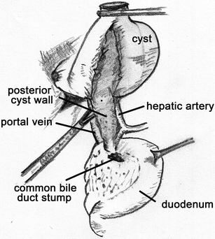 Management of Type I Choledochal Cyst in Adult: Totally Laparoscopic ...
