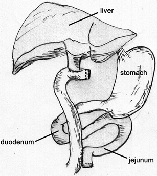 Management of Type I Choledochal Cyst in Adult: Totally Laparoscopic ...