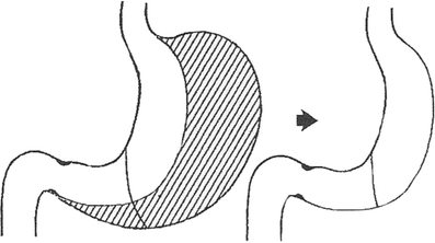 From Longitudinal Gastric Resection to Sleeve Gastrectomy—Revival of a ...