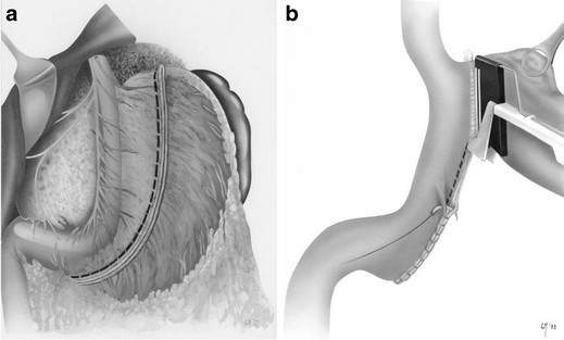 From Longitudinal Gastric Resection to Sleeve Gastrectomy—Revival of a ...