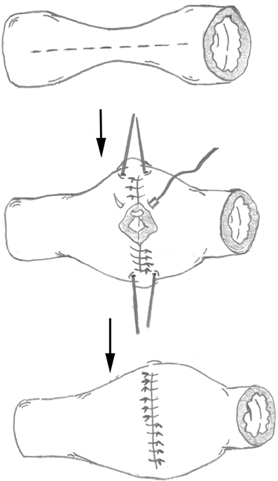 A Comprehensive Review of Strictureplasty Techniques in Crohn’s Disease ...