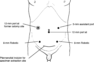Robotic-Assisted Proctectomy for Inflammatory Bowel Disease: A Case ...