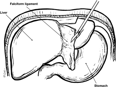 Use of the Falciform Ligament Flap for Closure of the Esophageal Hiatus ...