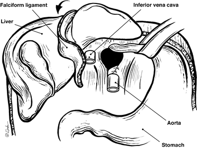 Use of the Falciform Ligament Flap for Closure of the Esophageal Hiatus ...